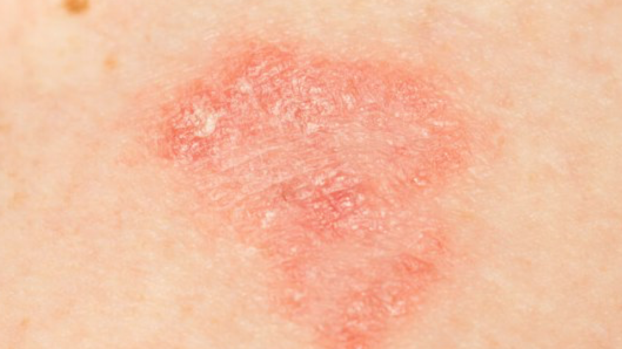 Dermatite atopica: in arrivo nuovi farmaci