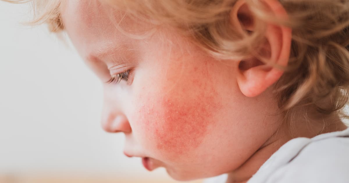 Dermatite atopica, quale alimentazione? - ISPLAD