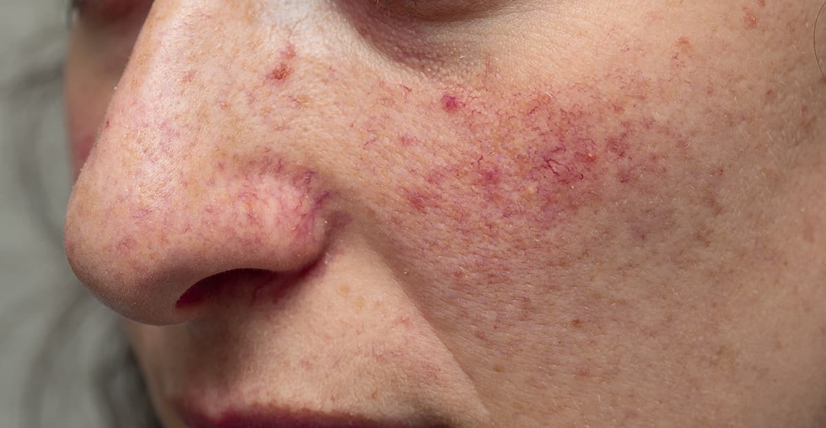 Rosacea, 10 cose da sapere - ISPLAD